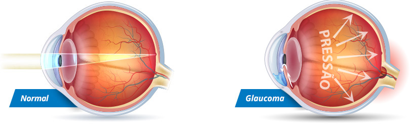 Glaucoma – Centro Oftalmológico Hospital Dia