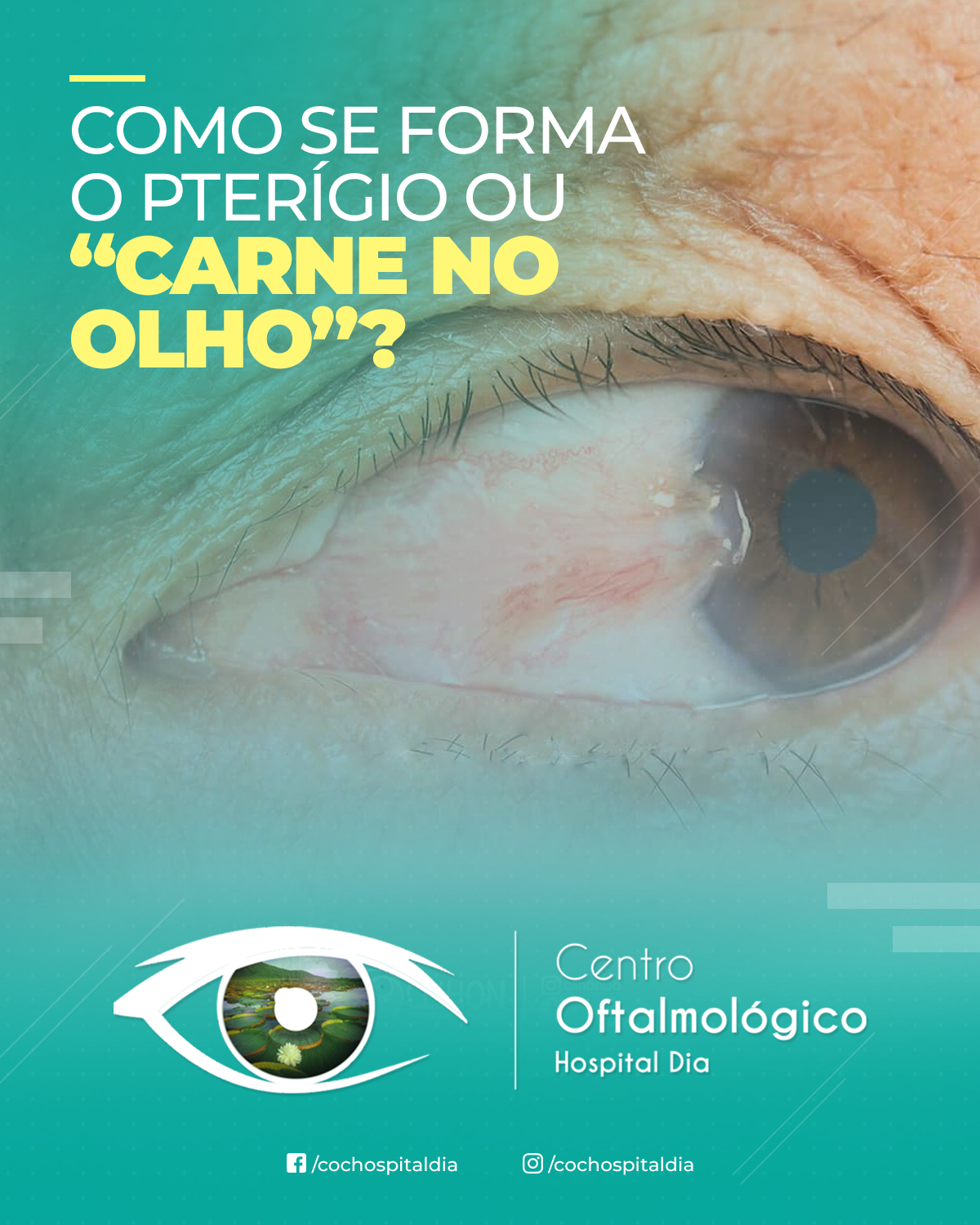 Pterígio: o que é, causas, sintomas, tratamento e prevenção – Centro ...